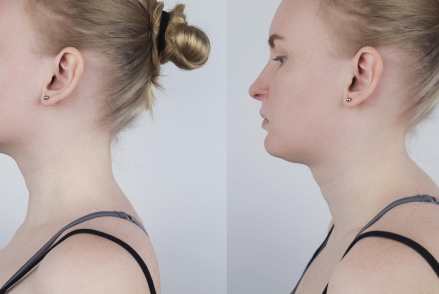 KIFOZA SVE ČEŠĆI PROBLEM I KOD MLADIH: Zašto se pojavljuje grba na ...